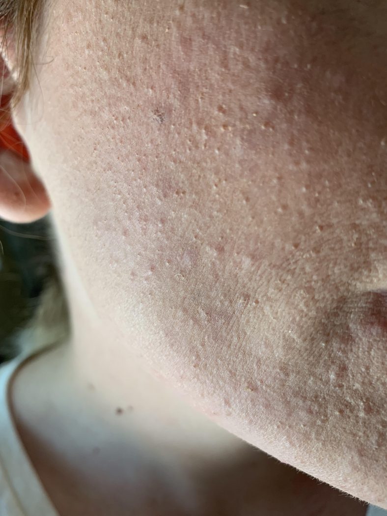 علت جوش های ریز صورت کودکان و بزرگسالان + درمان فوری - ستاره